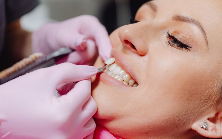 5 Rekomendasi Veneer Gigi di Jogja, Biar Gigi Kinclong Kayak Artis Korea!